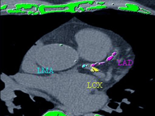 CALCIUM SCORE | Blue Star Imaging at the Star